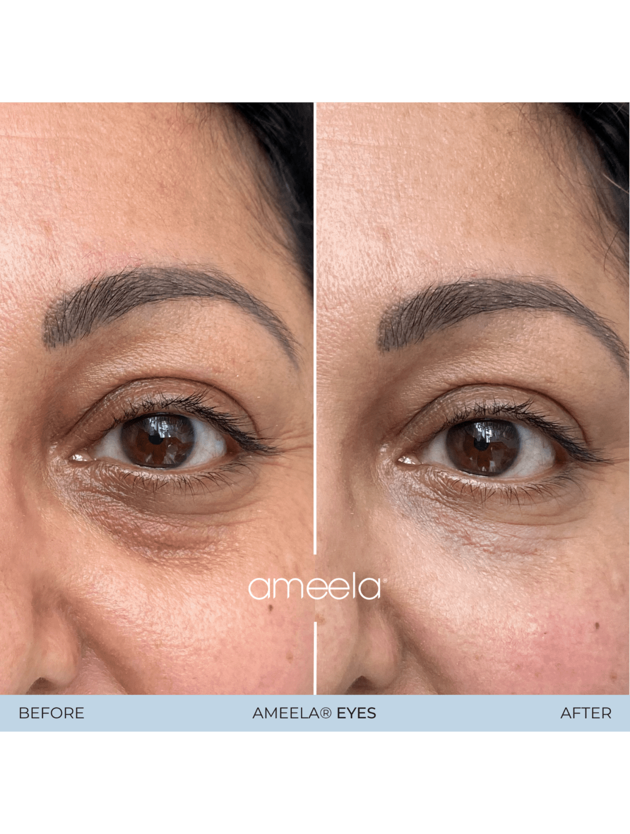 POLYNUCLEOTIDE TREATMENT - Roundhay Aesthetics