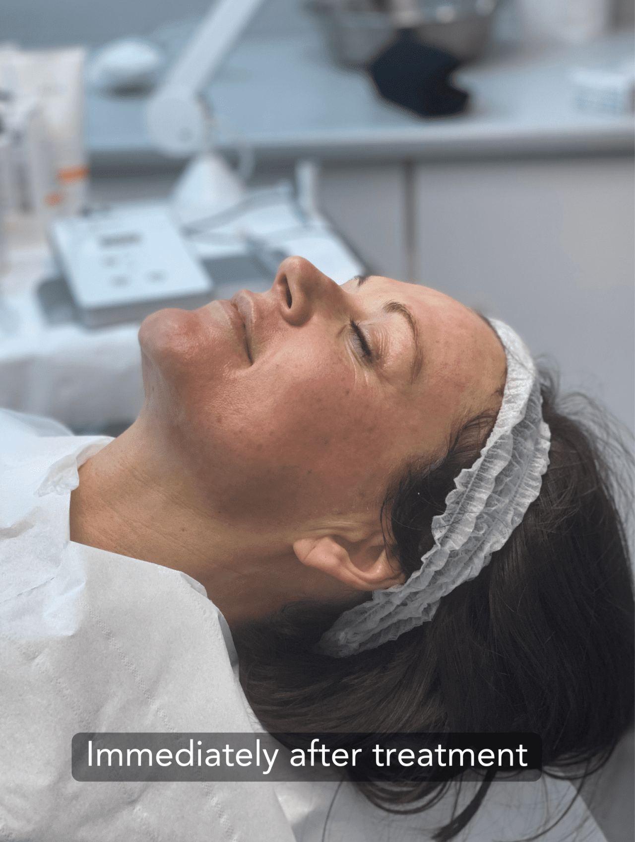DERMAL MICRO-NEEDLING - Roundhay Aesthetics - LEEDS