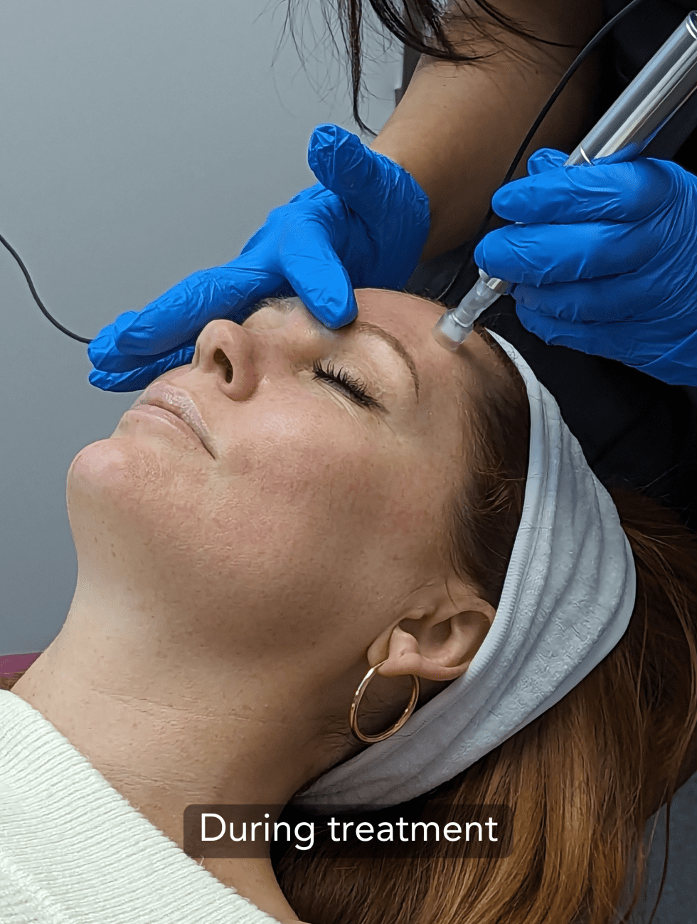 DERMAL MICRO-NEEDLING - Roundhay Aesthetics - LEEDS
