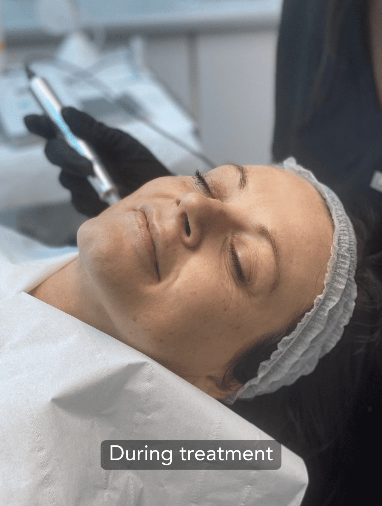 DERMAL MICRO-NEEDLING - Roundhay Aesthetics - LEEDS